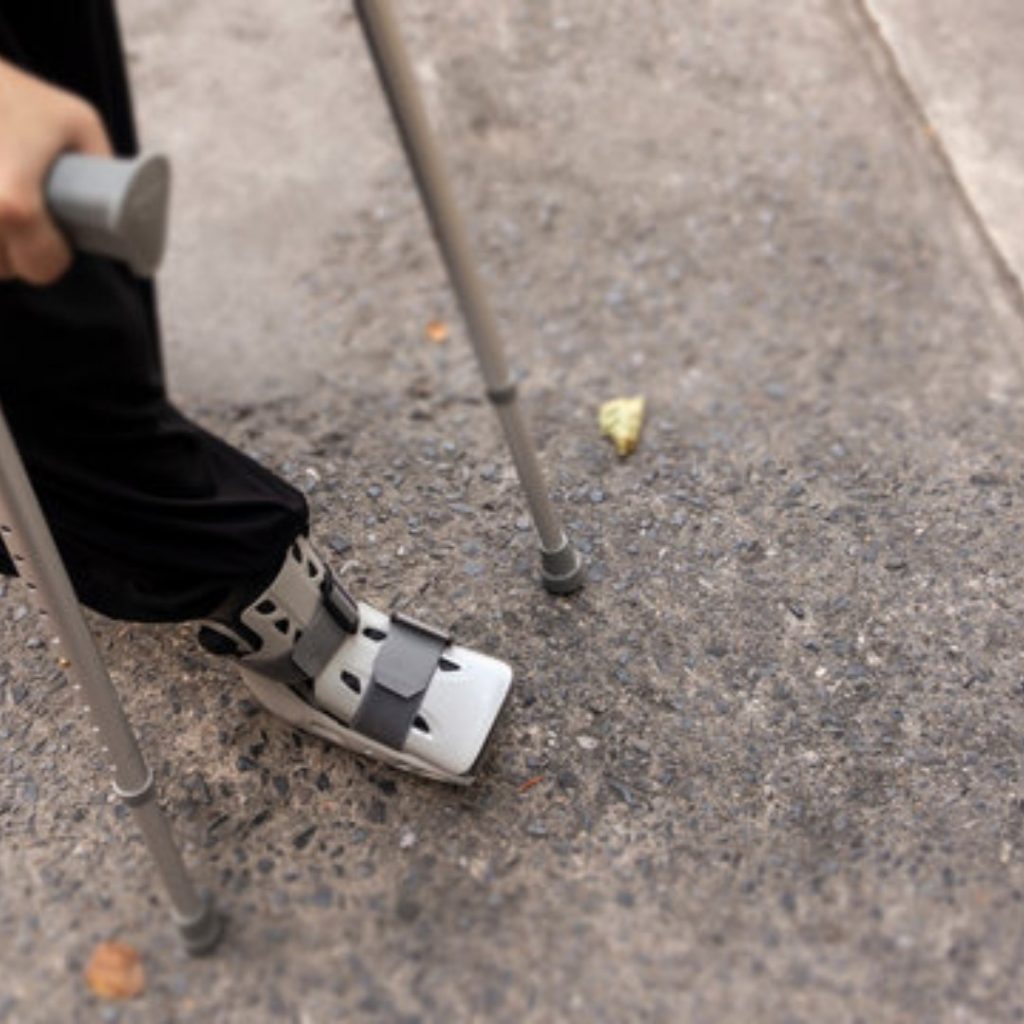 Bone Fractures and Breaks - what does recovery look like? - cssm